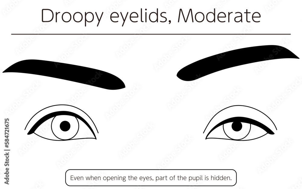 Medical illustration: Diagram of moderate ptosis (eyelid drooping ...
