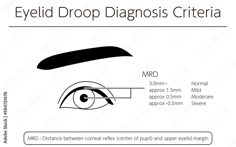 Poster Medical illustration: Diagram of severe ptosis (eyelid drooping ...