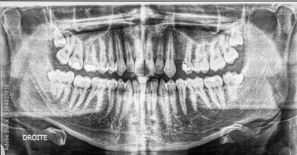 Dental panoramic radiograph with tooth gemination in the lower wisdom ...