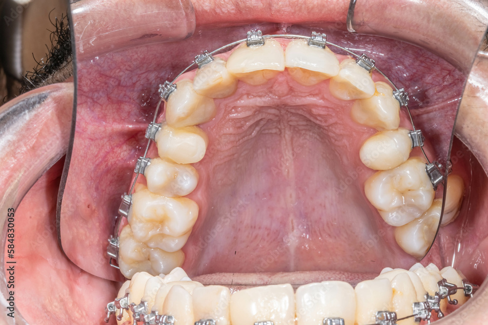 Dental orthodontics patient. Mirror indirect occlusal view of the ...