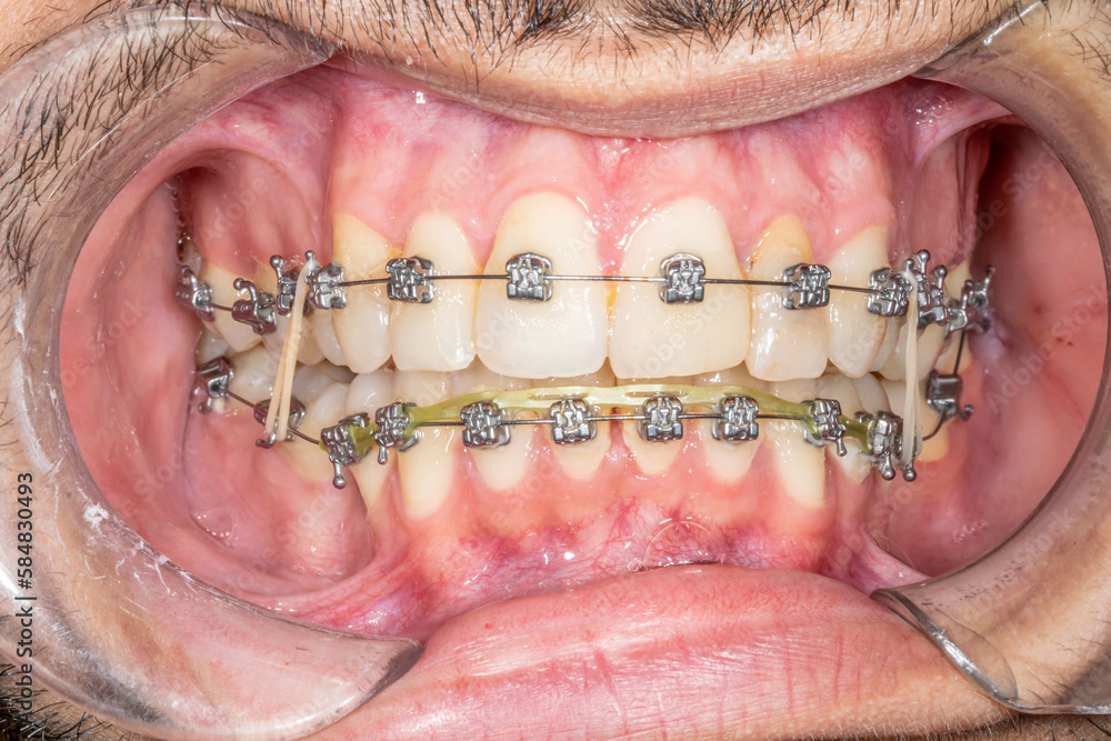 Dental orthodontics patient case man. Front view of arcades in ...