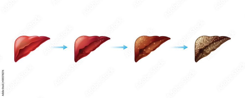 Scientific Designing of Chronic Liver Disease (CLD) Stages. Vector ...