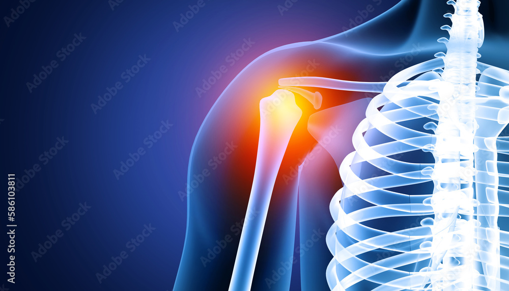Human shoulder joint pain, x-ray view, shoulder ligament tendinitis ...