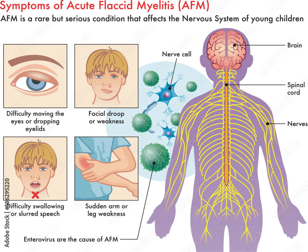 Medical illustration of Symptoms of Acute Flaccid Myelitis (AFM), with ...