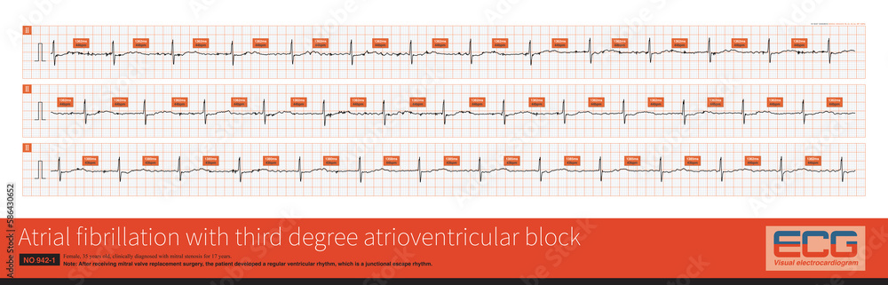 Cardiac surgery is one of the common causes of iatrogenic ...