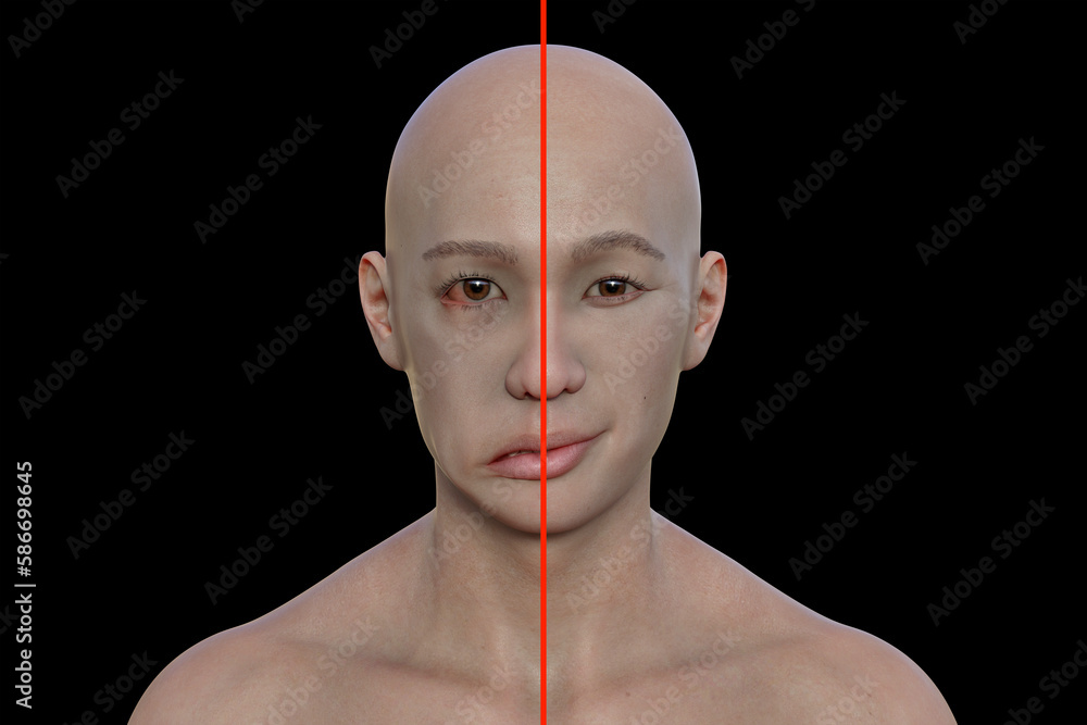 Facial palsy in a man, 3D illustration highlighting the asymmetry and ...