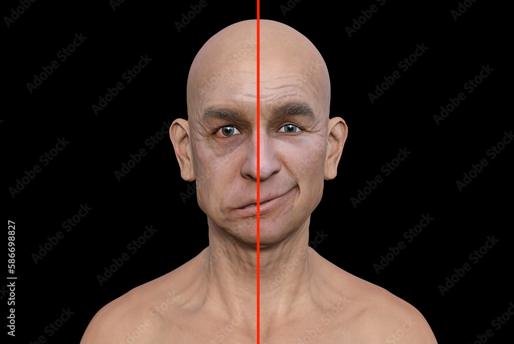 Facial palsy in a man, 3D illustration highlighting the asymmetry and ...