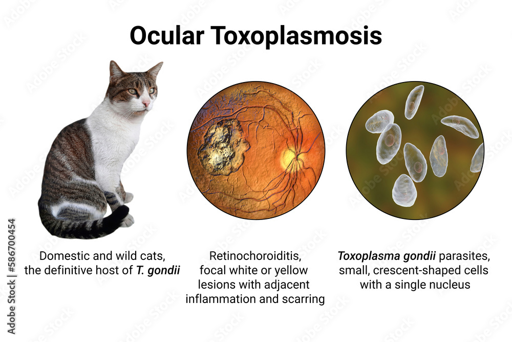 Ocular toxoplasmosis, retinal scar caused by a Toxoplasma gondii ...
