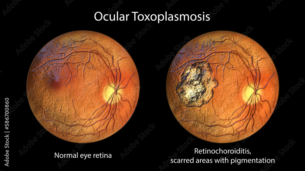 Retinal scar caused by a Toxoplasma gondii infection, or toxoplasmosis ...
