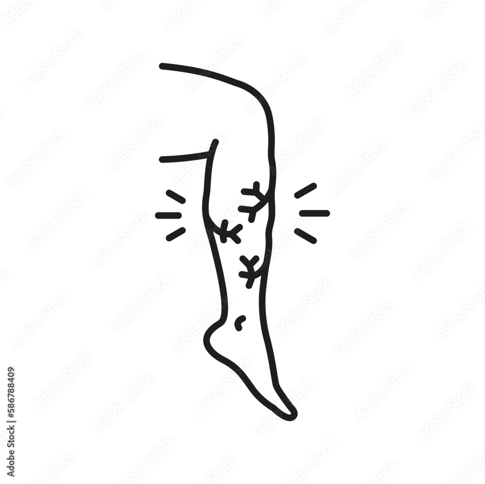 Varicose vein, vascular mesh on legs. Vector icon venous edema ...