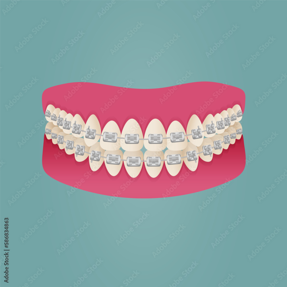 The concept of teeth alignment with braces. Orthodontic dentistry. The ...