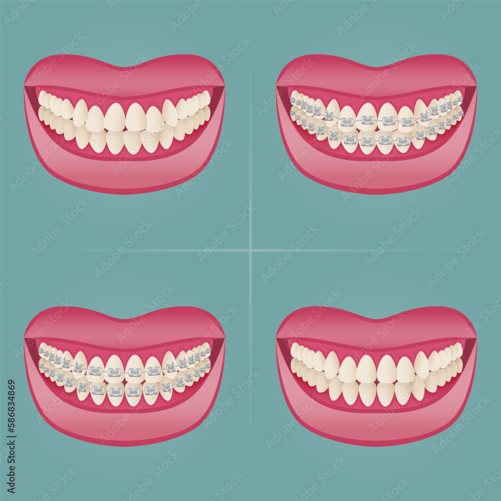 The concept of teeth alignment with braces. Orthodontic dentistry. The ...