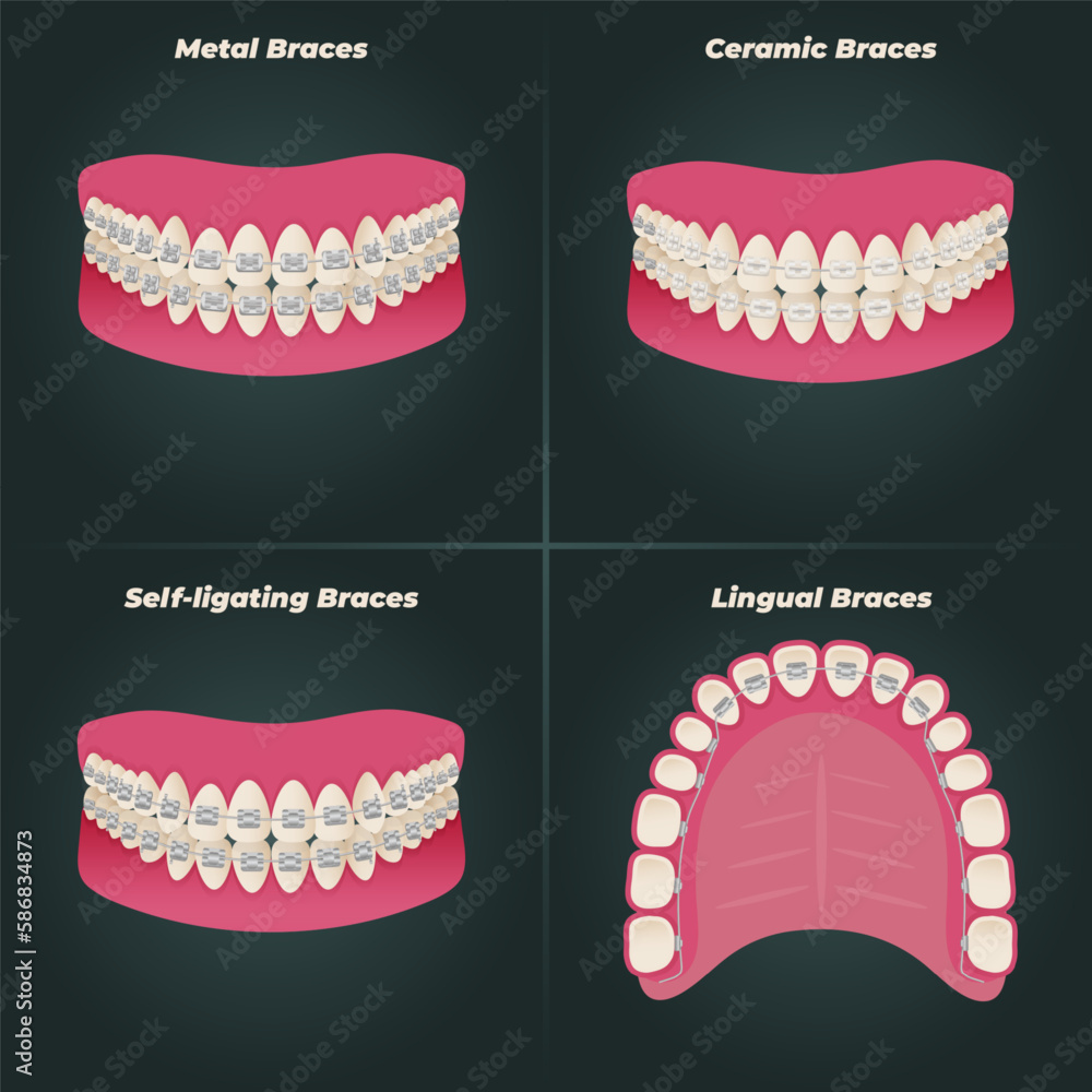 The concept of teeth alignment with braces. Orthodontic dentistry. The ...