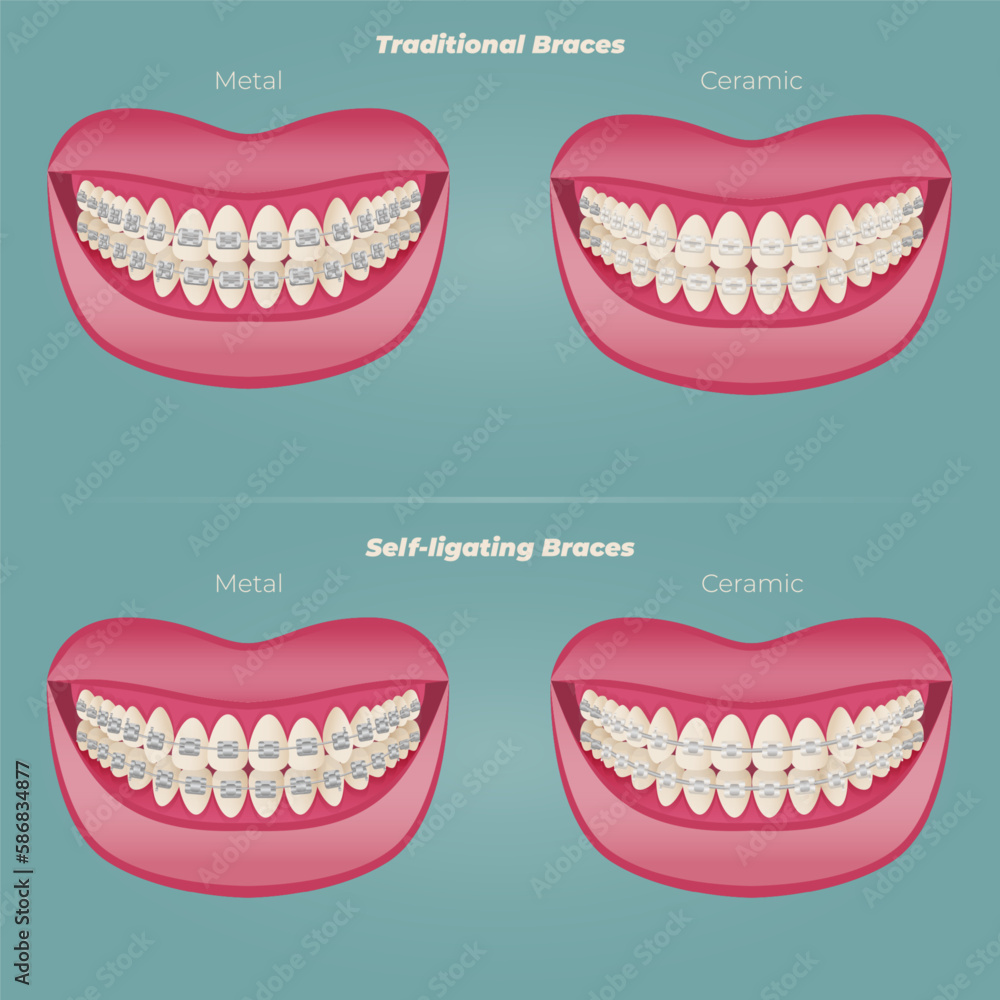 The concept of teeth alignment with braces. Orthodontic dentistry. The alignment of the teeth ...