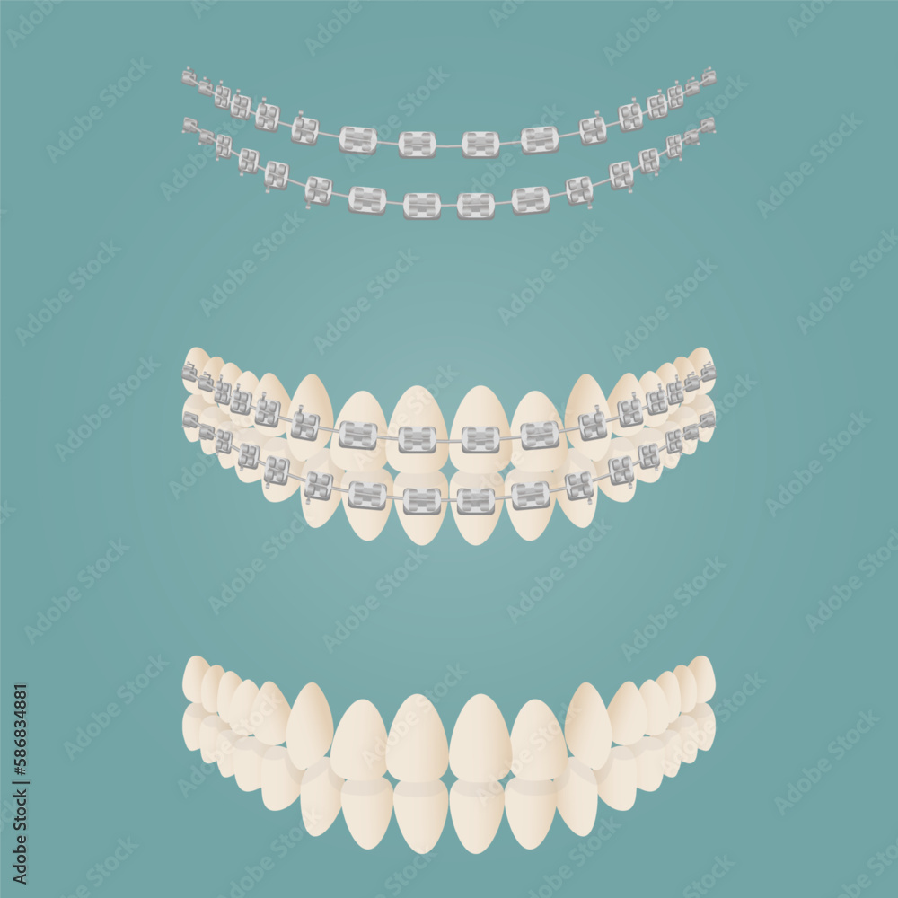 The concept of teeth alignment with braces. Orthodontic dentistry. The alignment of the teeth ...
