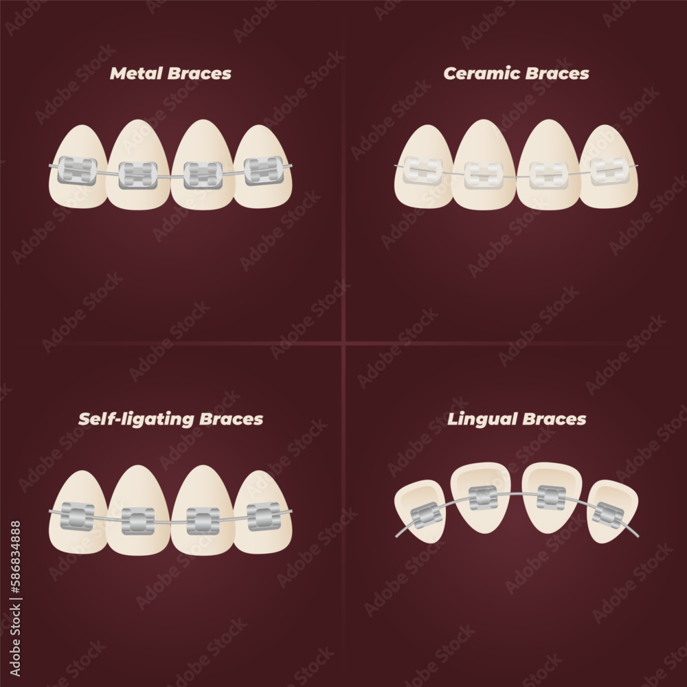 The concept of teeth alignment with braces. Orthodontic dentistry. The ...