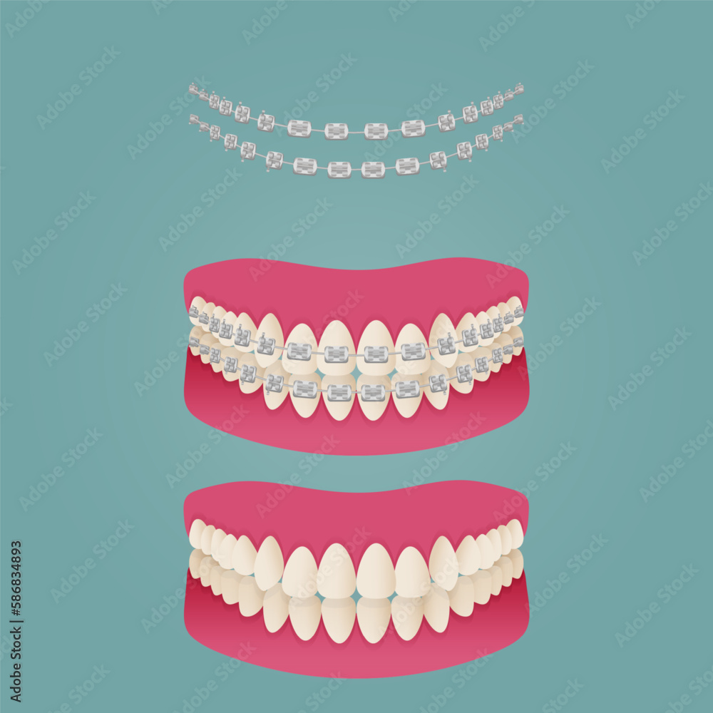The concept of teeth alignment with braces. Orthodontic dentistry. The ...
