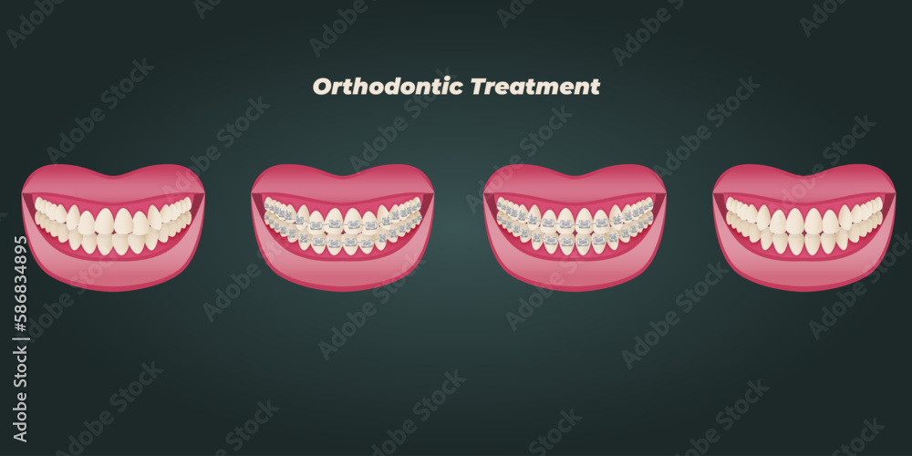 The concept of teeth alignment with braces. Orthodontic dentistry. The ...