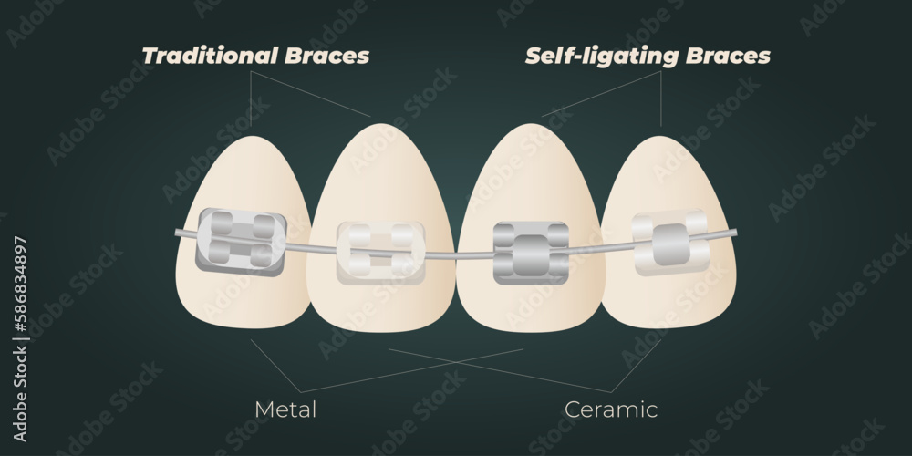 The concept of teeth alignment with braces. Orthodontic dentistry. The ...
