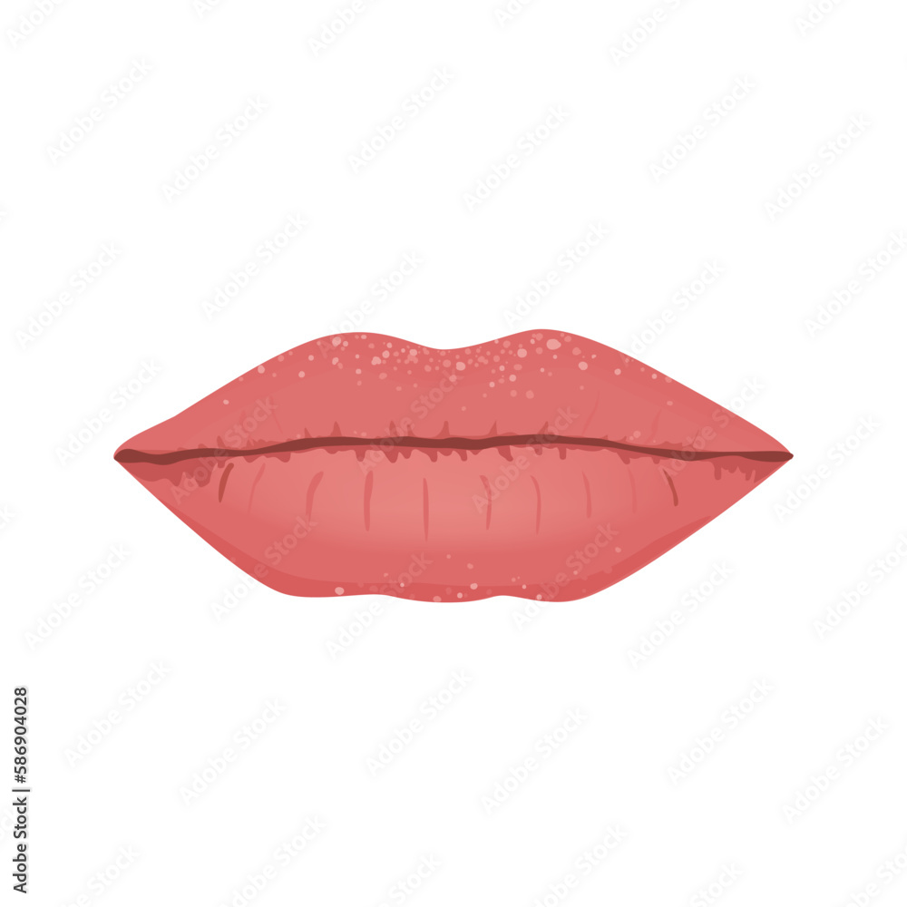 Fordyce Spots on Lips, Isolated Vector Illustration. Fordyce granules ...