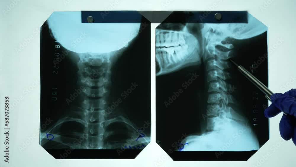 Side and front view of neck roentgen. Doctor's hand pointing on x ray ...