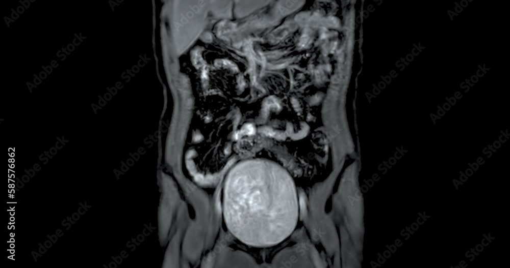 Magnetic resonance urography (MR urography) is a MRI study that ...