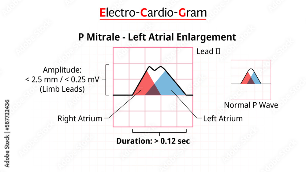 Vecteur Stock P Wave P Mitrale ECG Left Atrial Enlargement Vecteur Stock P Wave P Mitrale ECG Left Atrial Enlargement
