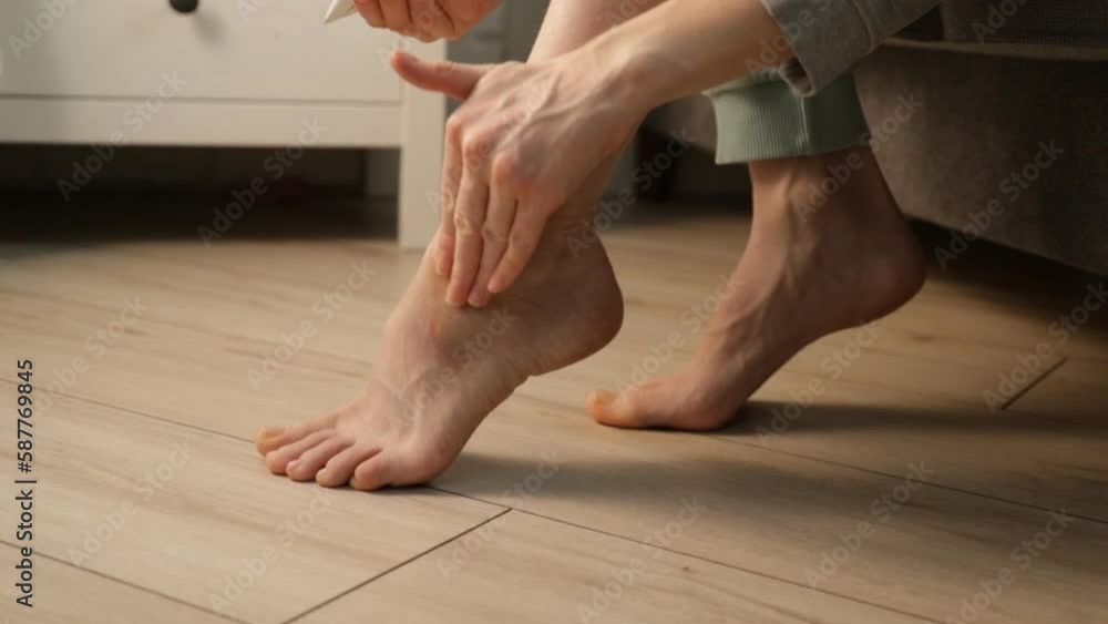 Sprained ankle with bruise and swelling on a female left foot on white ...