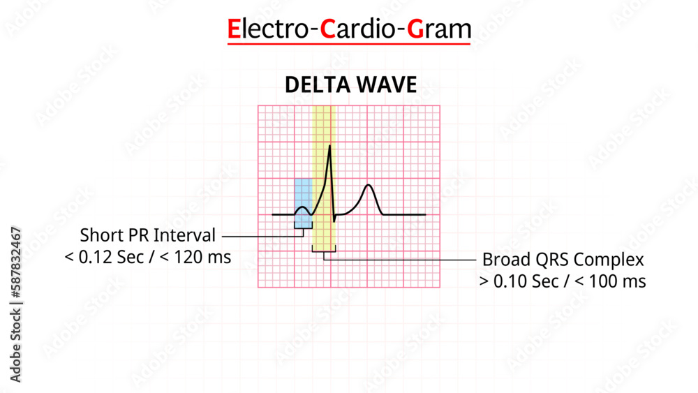 Delta Wave - ECG Morphology - Electrocardiogram - Vector Illustration ...