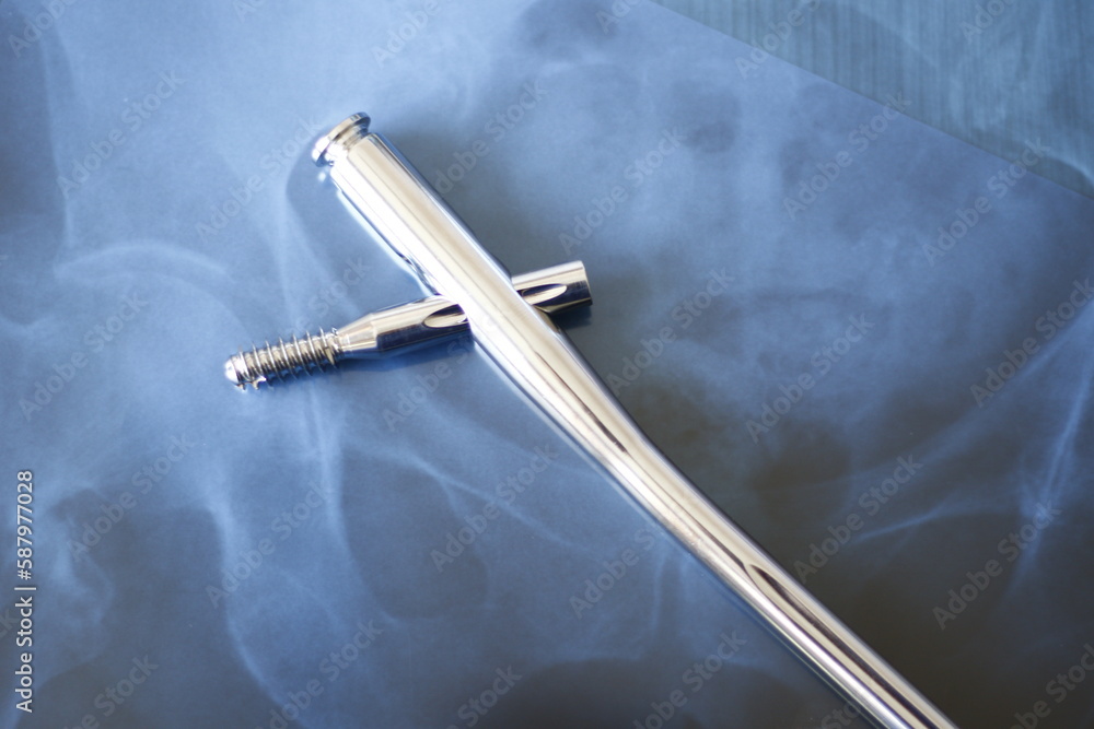 Surgical plates and instruments for osteosynthesis in case of bone ...