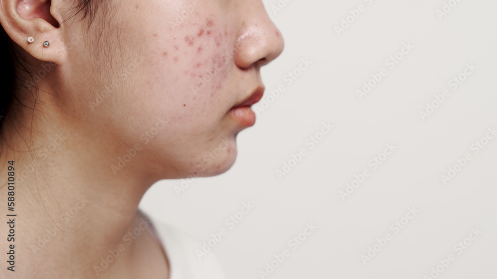 Asian teenage with acne face skin problem, Dermatological disease ...