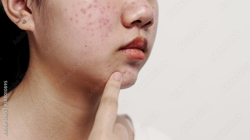 Asian teenage with acne face skin problem, Dermatological disease ...