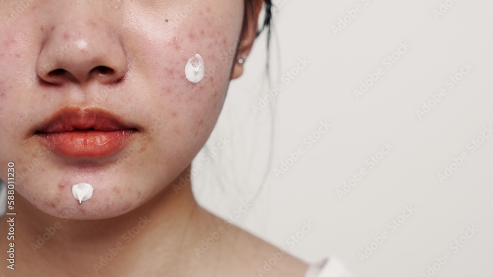 Asian teenage with acne face skin problem, Dermatological disease ...