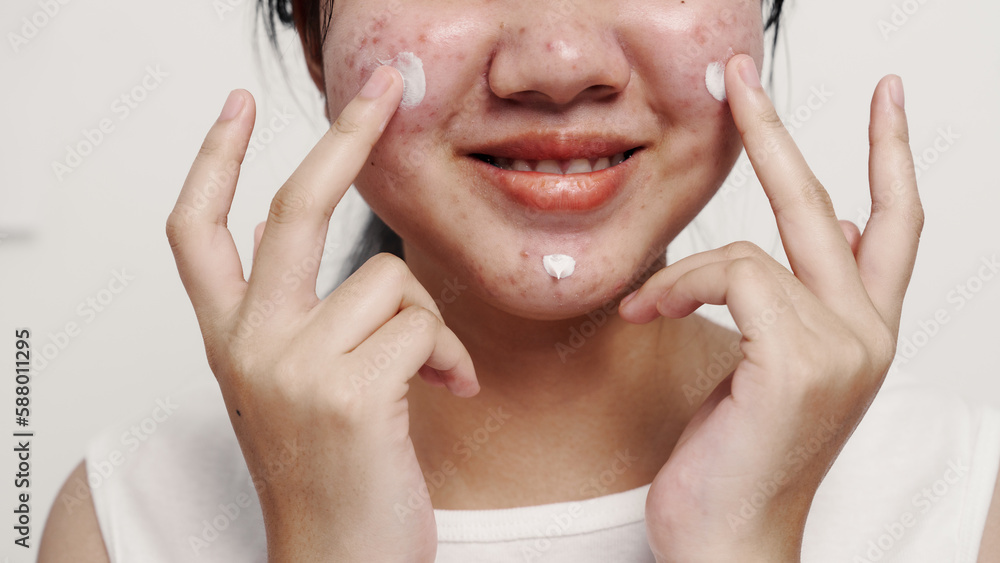 Asian teenage with acne face skin problem, Dermatological disease ...