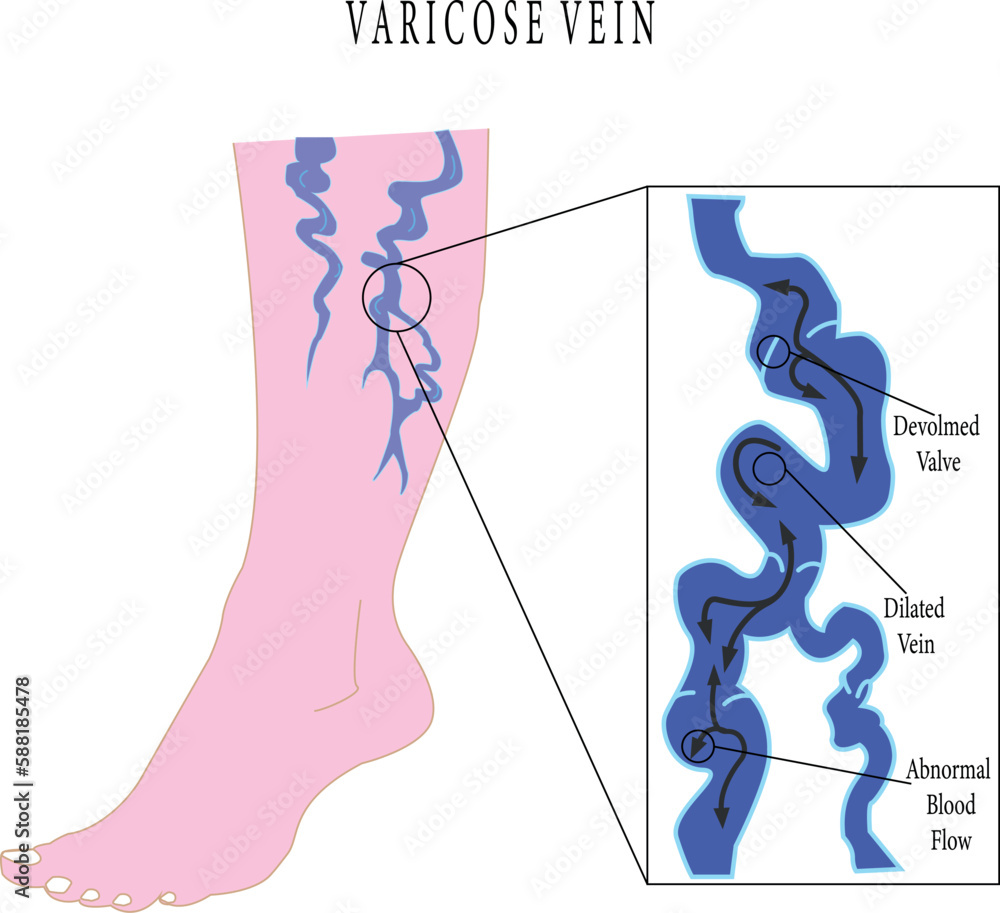 Varicose veins poster. Vector flat style cartoon varicose illustration ...