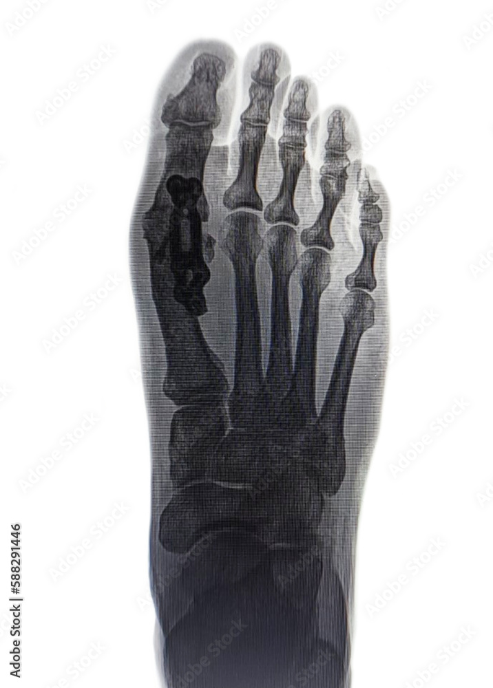 Xray image of Bone block distraction arthrodesis - MTP1 of the hallux ...