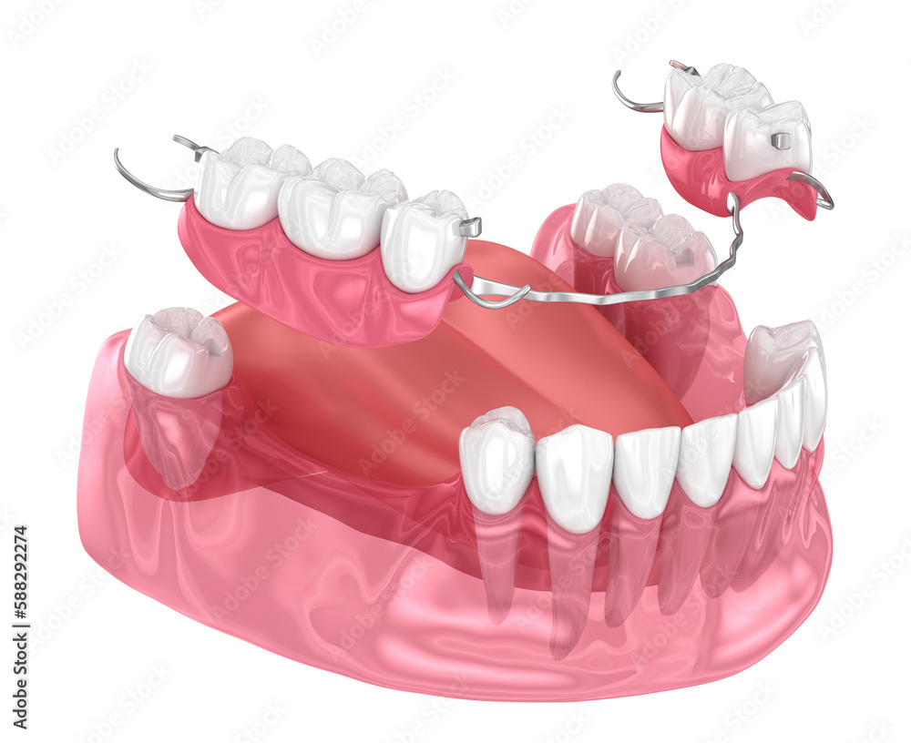 Removable partial denture, mandibular prosthesis. Medically accurate 3D ...