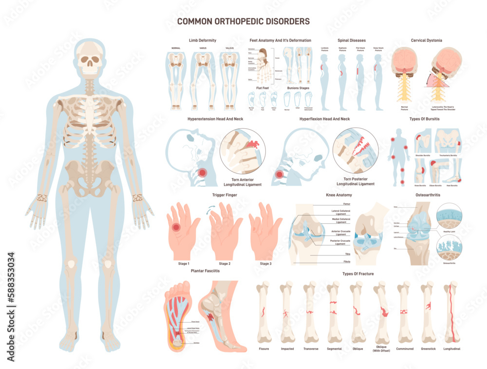 Orthopedic diseases set. Human skeleton, ligament and joints injuries ...