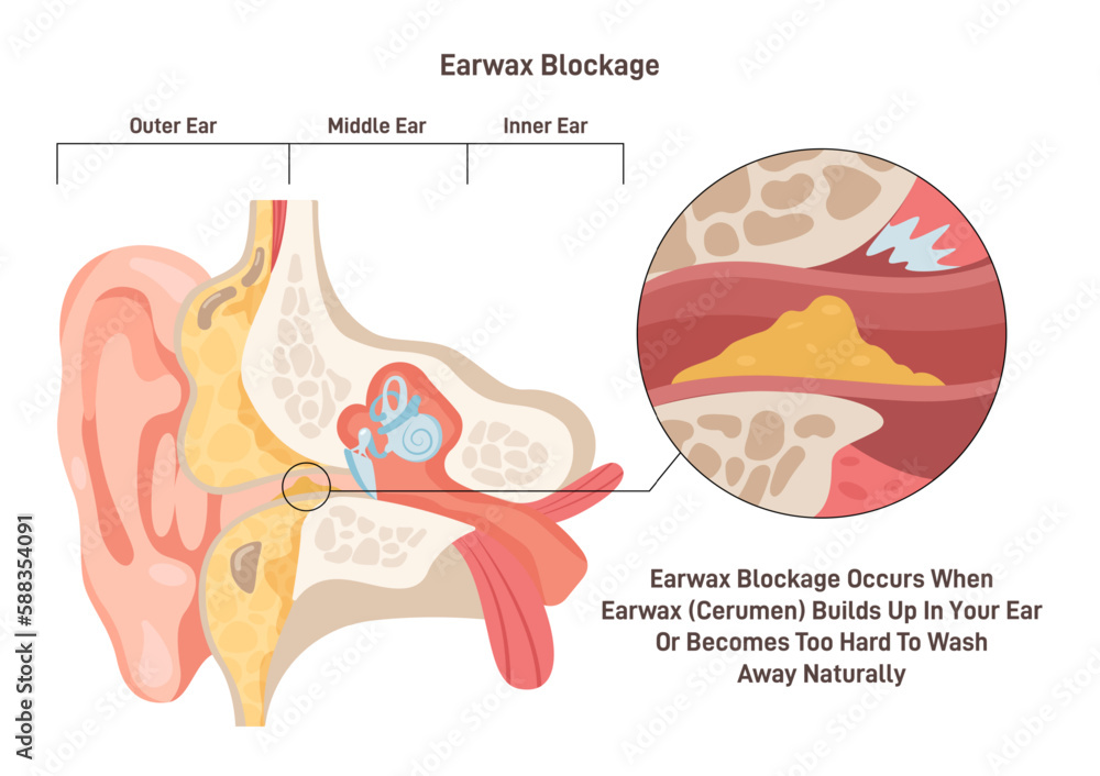 Earwax blockage. Cerumen impaction, medical condition of an middle ...