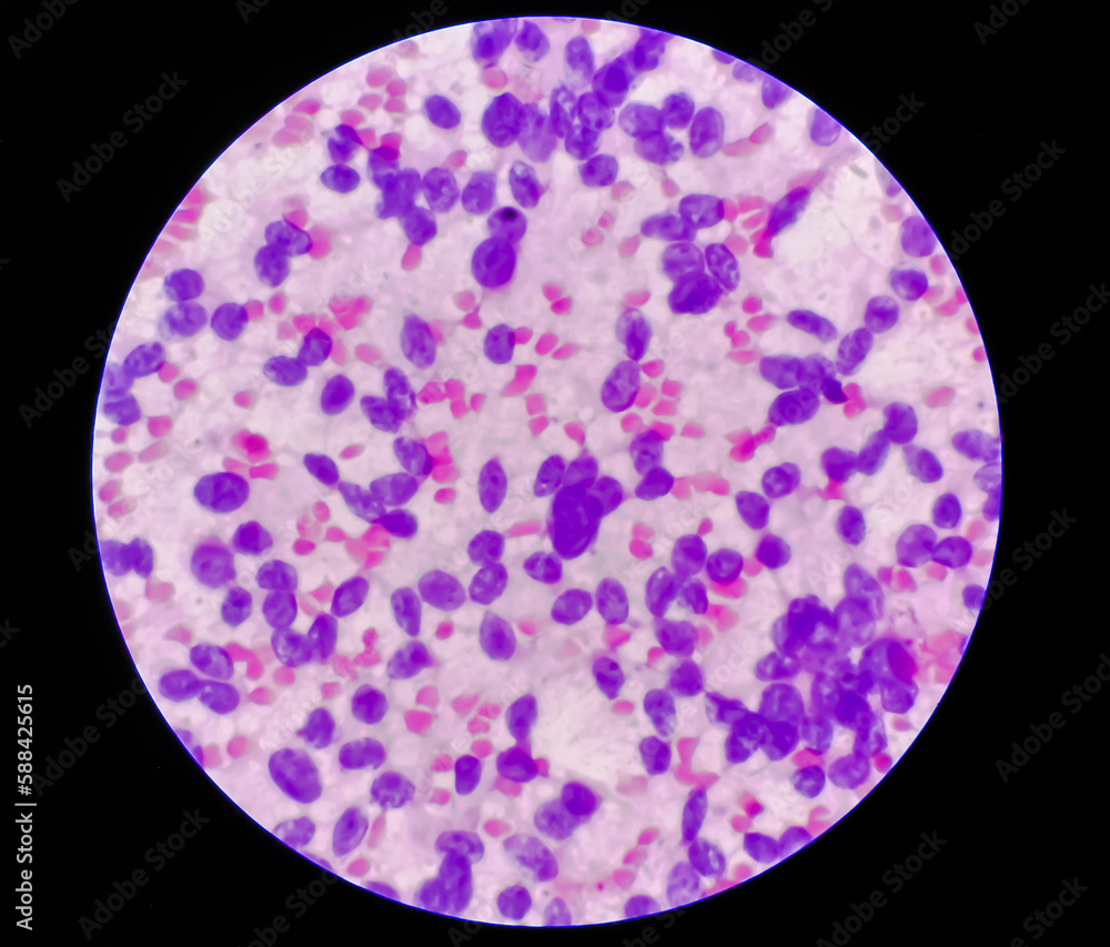 USG guided FNA cytology of liver SOL showing Non Hodgkin lymphoma ...