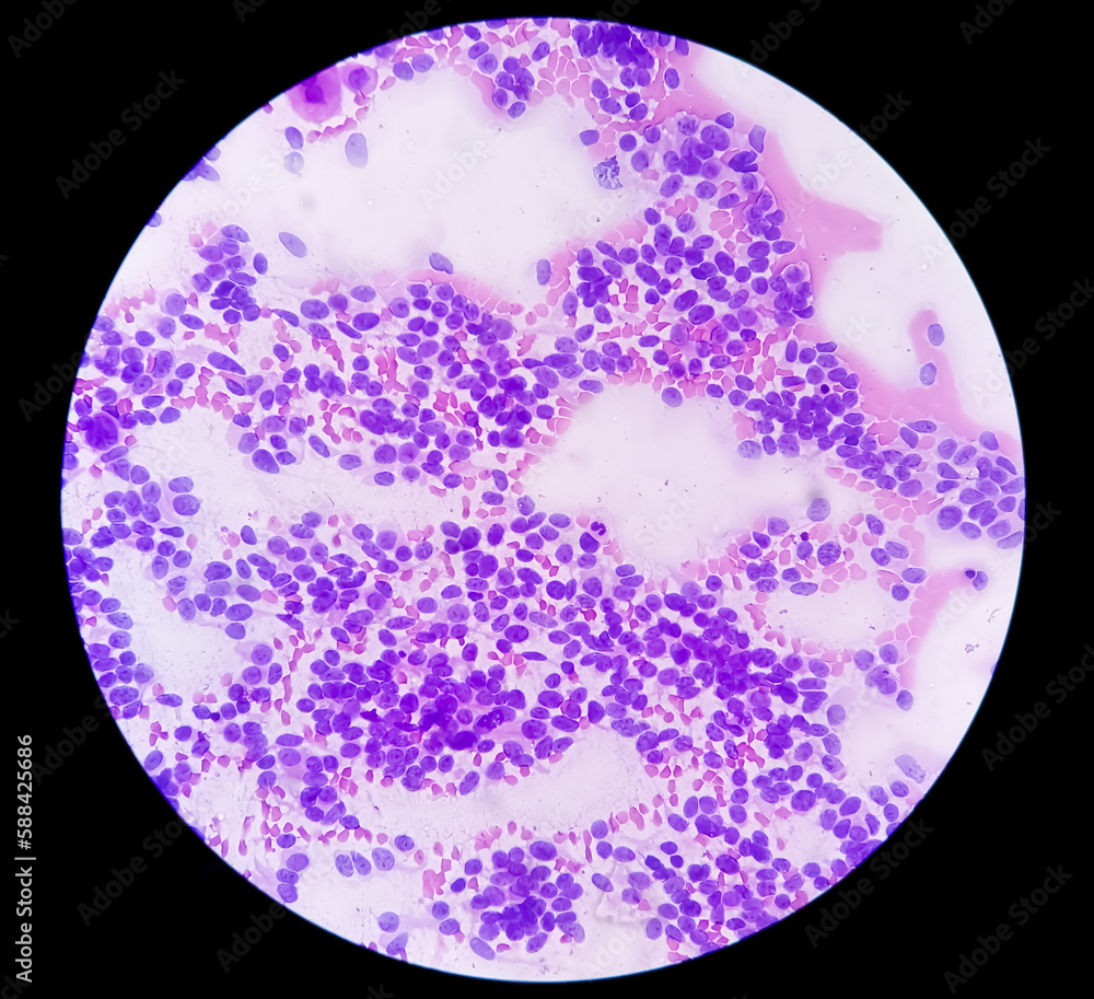 USG guided FNA cytology of liver SOL showing Non Hodgkin lymphoma ...