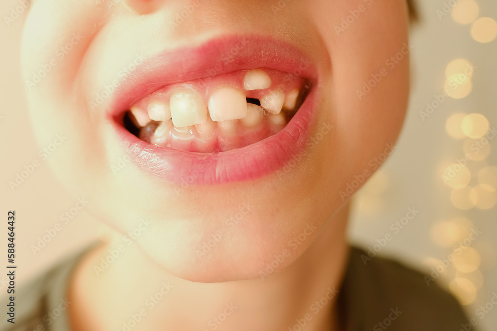Foto de closeup crooked teeth, boy 9-10 years opened mouth, child 8 ...