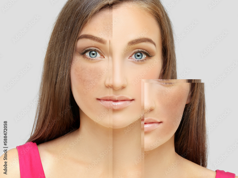 Dark spots, freckles,hyperpigmentation(melasma or chloasma),concept ...