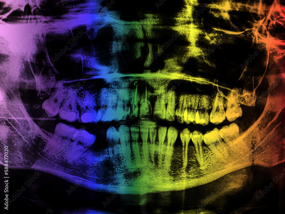 X-ray teeth mandible human skull. Panoramic negative photo facial image ...