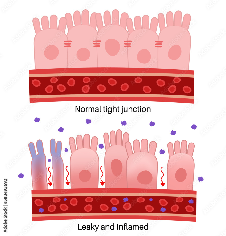 Leaky Gut Syndrome : Normal tight junction, Leaky and Inflammation ...