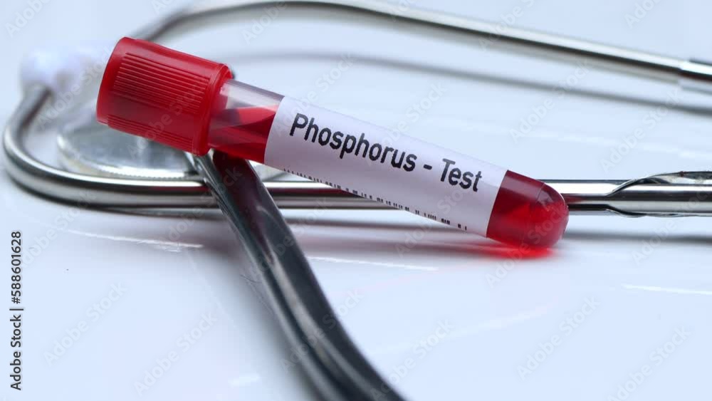 Phosphorus test to look for abnormalities from blood, blood sample to ...