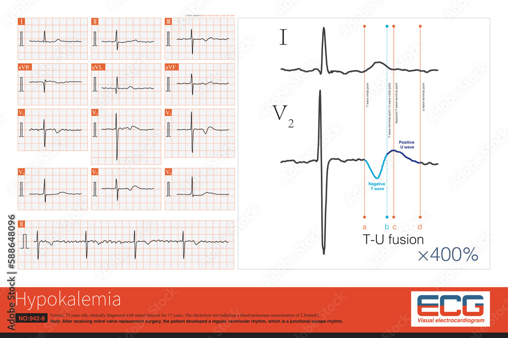 When hypokalemia occurs, the inverted T wave merges with the enlarged ...