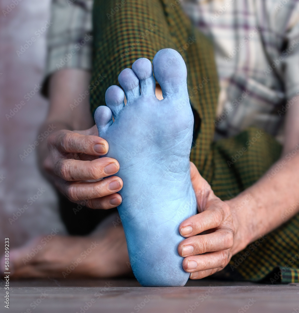 Light blue colored sole of Asian man. Concept of tingling and numbness ...