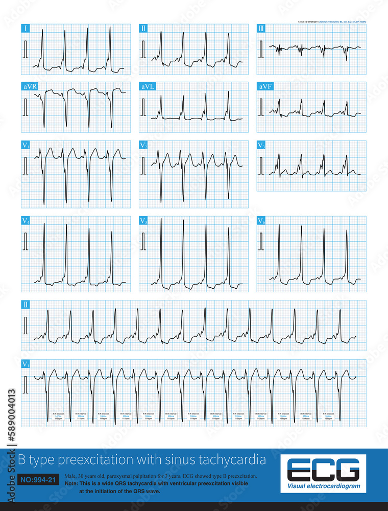 When patients with overt preexcitation experience sinus tachycardia ...