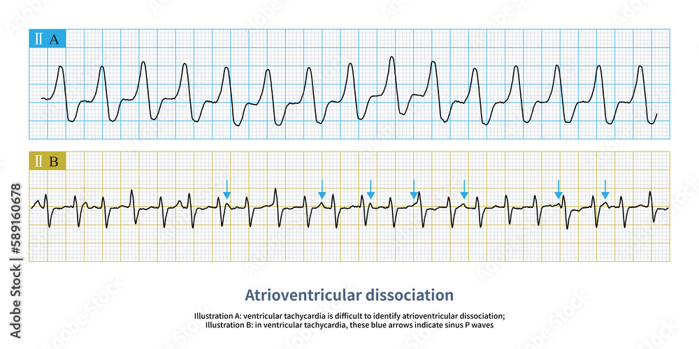 Atrioventricular dissociation is a clue to the diagnosis of VT. The ...
